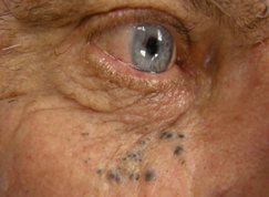 What are comedones and how to get rid of them? – FarmaOn