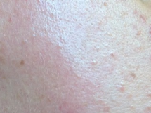 What are comedones and how to get rid of them? – FarmaOn